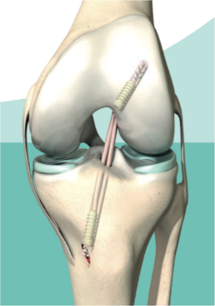 ACL Surgery With Internal Brace In Raipur - Dr Barik Orthocare